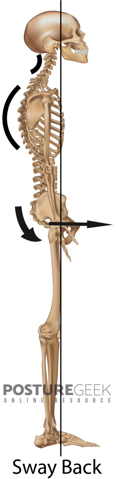 Sway Back Posture: Characteristics and Causes | PostureGeek.com