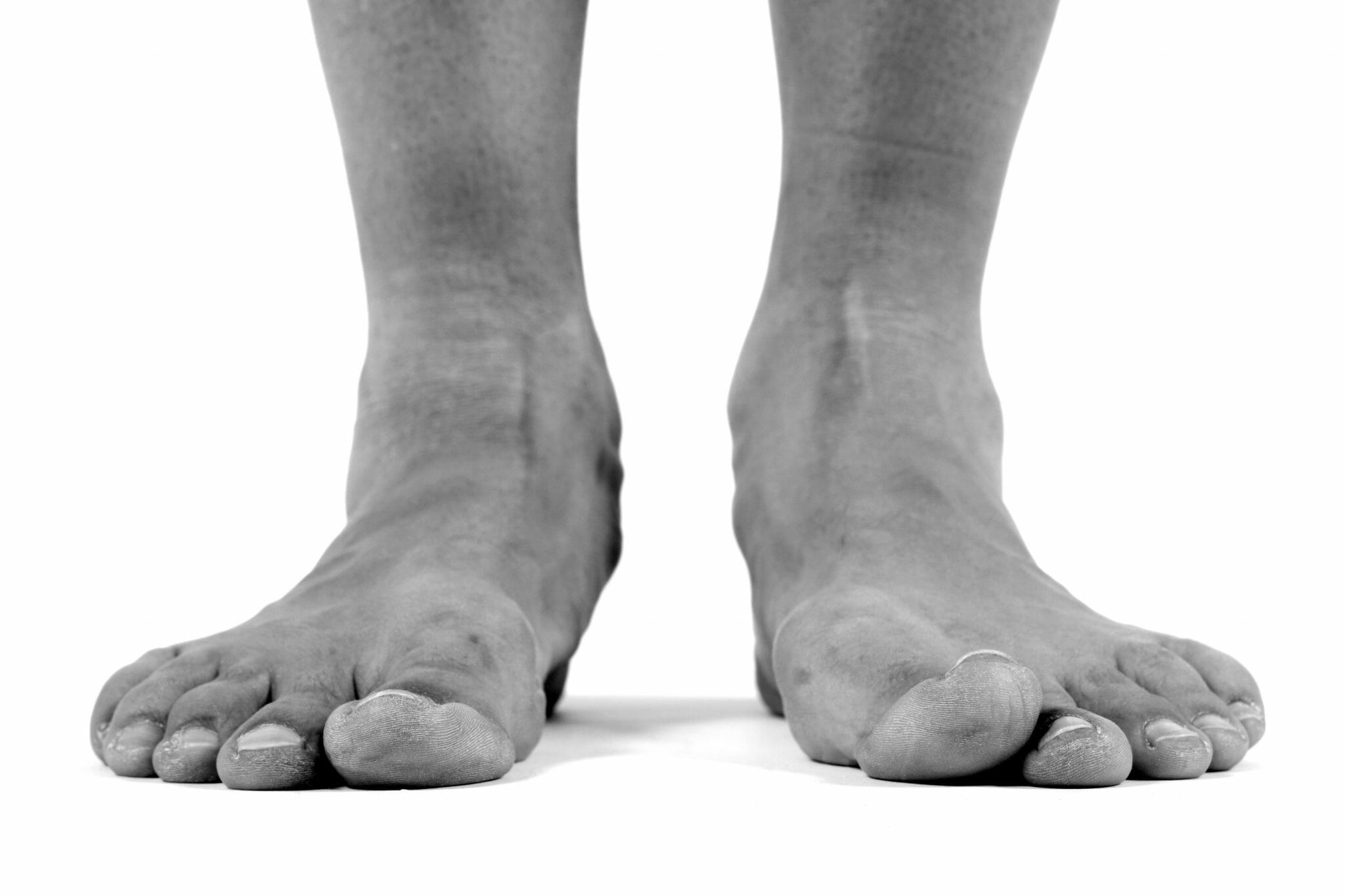 Flat Feet: Symptoms, Diagnosis, And Treatment