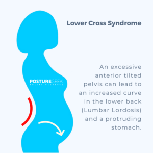 Upper Cross Syndrome and Lower Cross Syndrome - Janda