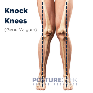 Knocked Knees: Causes, Symptoms and Possible Solutions | PostureGeek