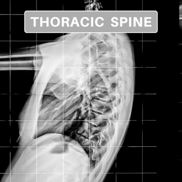 Scheuermann Disease: Symptoms, Diagnosis, & Treatment