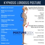 Kyphosis Lordosis Posture | PostureGeek.com