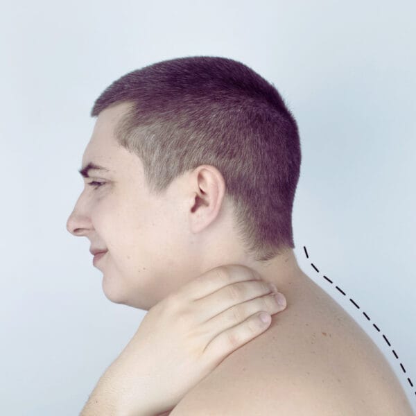 Kyphosis Lordosis Posture: Understand its Causes and Solutions