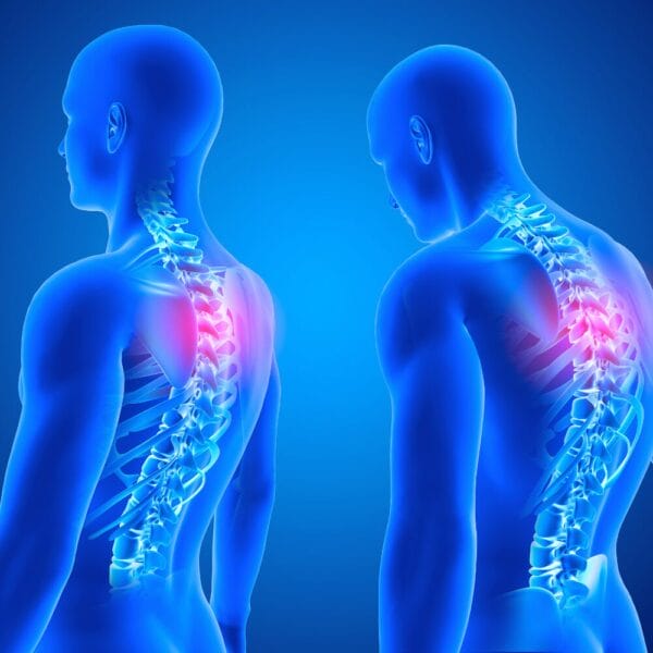 Slipping Rib Syndrome: Symptoms, Causes, and Treatment