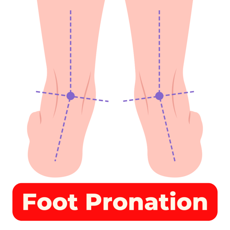 Foot Pronation: Impact on Posture, Movement, and Health